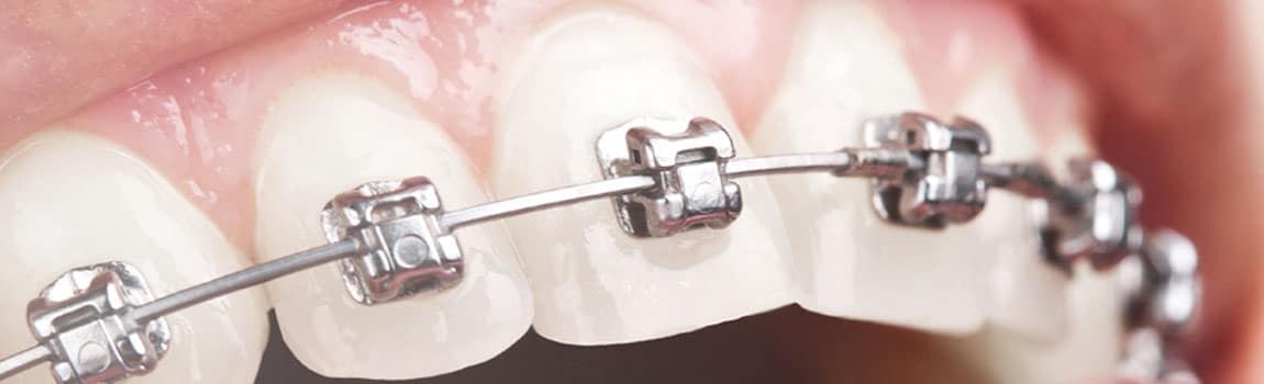 Eisenberger Orthodontics – Invisalign & Braces in Brooklyn